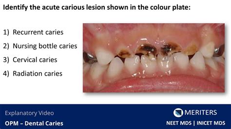 Radiation Caries