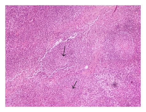 Preserved Lymph Node Architecture Residual Follicles With Atretic