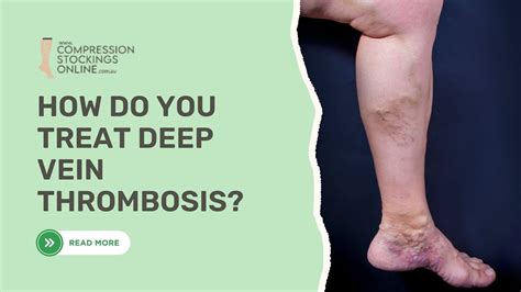 How Do You Treat Deep Vein Thrombosis Compression Stockings Online
