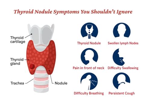 Thyroid Nodule Symptoms And Non Surgical Treatments