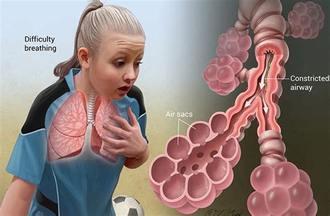 Asthma Understanding The Disease Management And Standard Treatment Guidelines