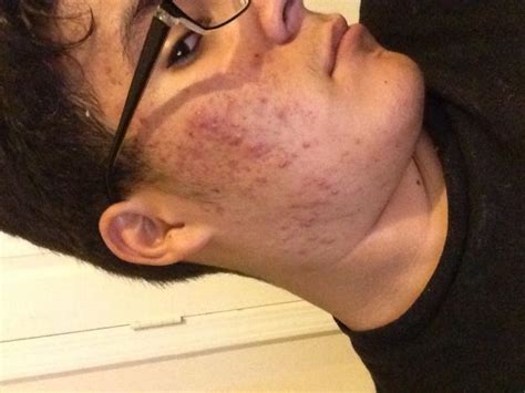 What Kind Of Acne Is This Different Person General Acne Discussion Acne Org Forum