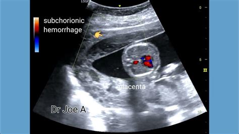 Subchorionic Hemorrhage And Hematoma In 2nd Trimester Pregnancy Ultrasound And Color Doppler
