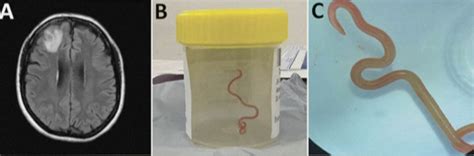 Australian Doctors Find Live Parasitic Worm In Woman S Brain