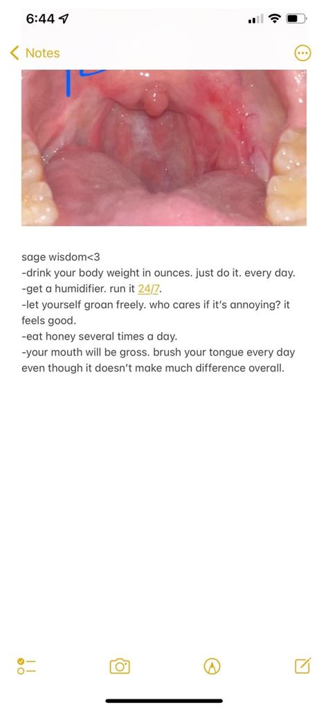 My Tonsillectomy Recovery Daily Photos Included 48 Days Post Op R Tonsilstones