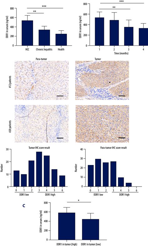 The Expression Of Ddr1 Was Increased In Serum And Tumor In Hcc