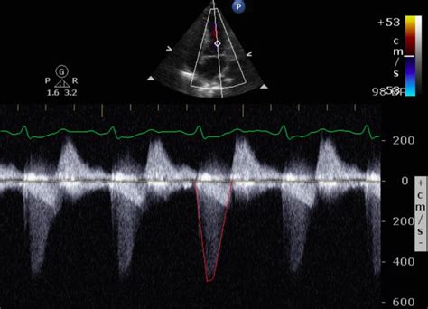 The Disappearing Murmur Systolic Anterior Motion Of The Mitral Valve