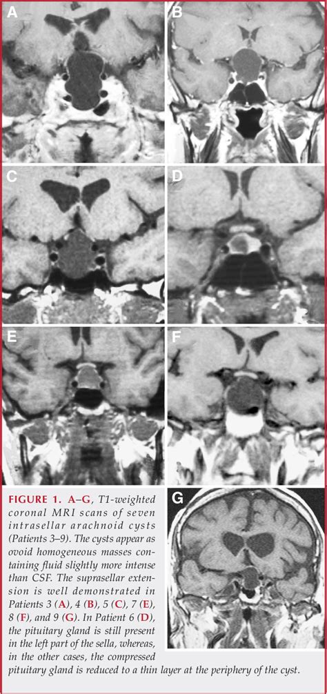 Figure 1 From Intrasellar Arachnoid Cysts Semantic Scholar