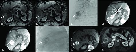 Drug Eluting Beads Transarterial Chemoembolization In A 55 Year Old Download Scientific Diagram