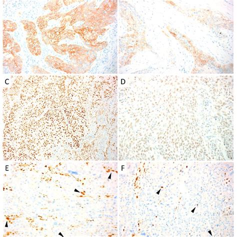 Representative Cases Of Positive Immunohistochemistry Stain Cancer