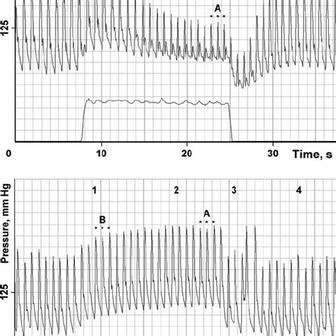 Regression Coefficients For PCWP With PPR And AUC For PCWP 15 MmHg In Download Table