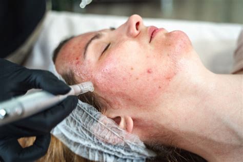 Everything You Need To Know About Atrophic Scars