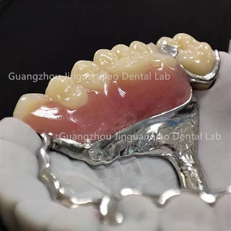Digital Dental Crowns Rpd Dental Lab Price Custom Removable Dentures