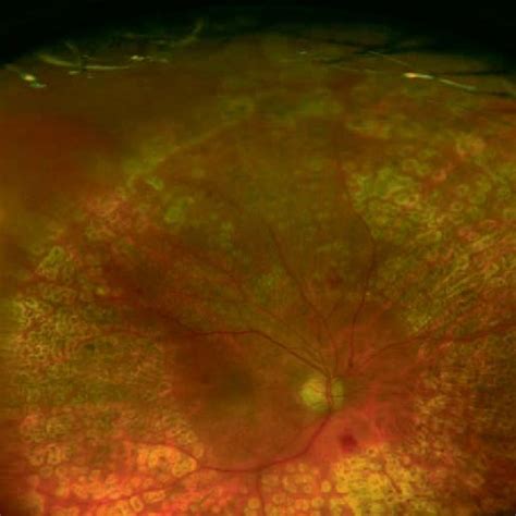 The Mackie Classification System For Neurotrophic Keratopathy The Mackie Classification System For Neurotrophic Keratopathy