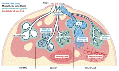 Dsa16 Benign And Malignant Disease Of The Breast Flashcards Quizlet