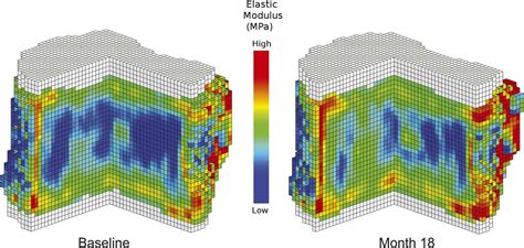 Fragility Fracture Risk Prediction Beyond Bmd Orthobuzz