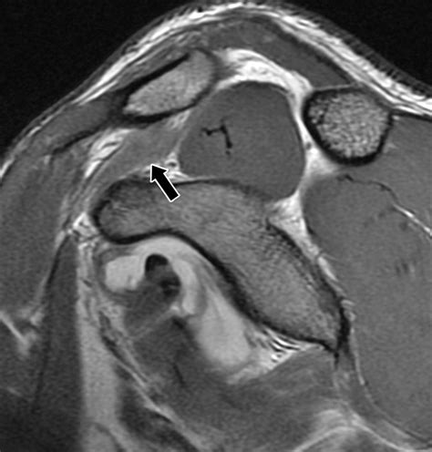 Imaging Of The Acromioclavicular Joint Anatomy Function Pathologic Features And
