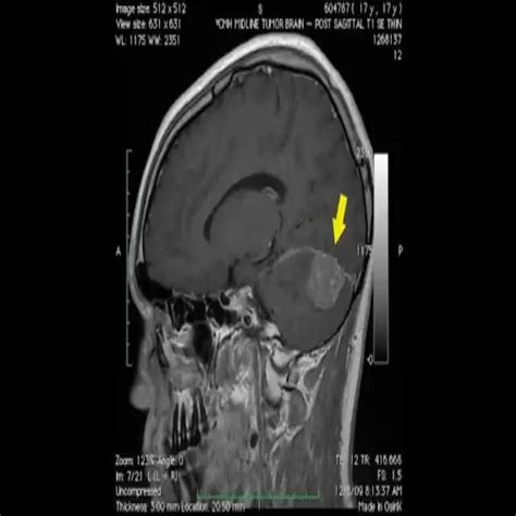 Brain Tumor Detection Object Detection Dataset V2 Mahitha By Brain Tumor