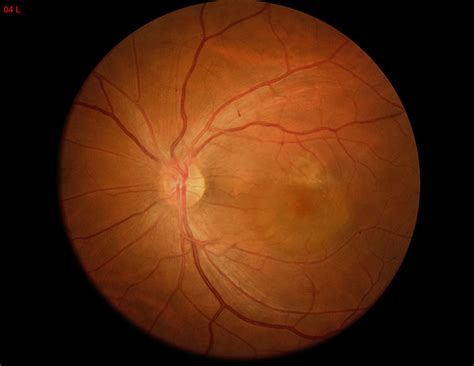 Central Serous Retinopathy Treatment Synergy Eye Care