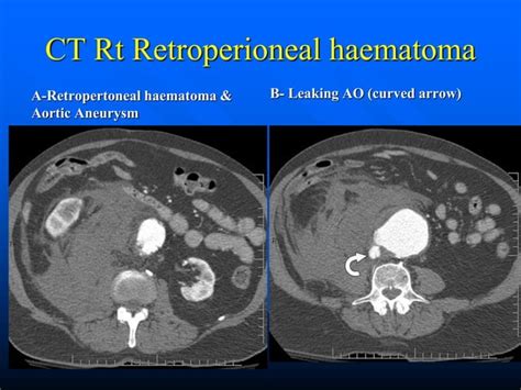 Retroperitoneal Hematoma Types And Management The Lectppt