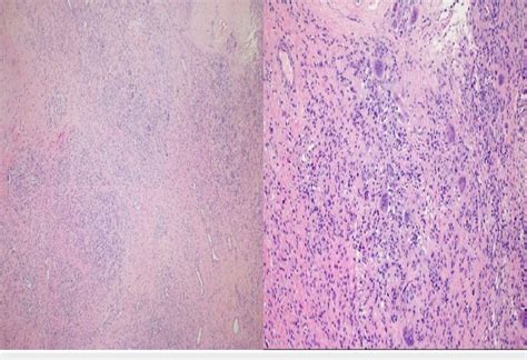 Histopathological Appearance Showed Polymorphous Population Of Cells Download Scientific