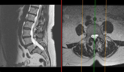 Disc Bulge