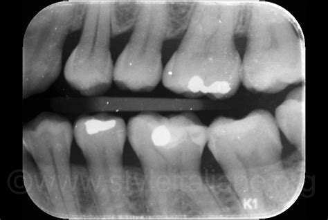 What Do Caries Look Like On X Ray At Lola Wall Blog