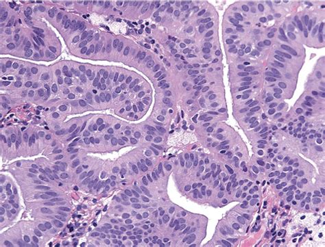 Endometrial Hyperplasia Cells Are Enlarged Relative To The Uninvolved