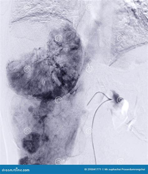Transarterial Chemoembolization Tace Stock Image Image Of Health