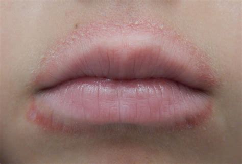 Fungal Infection On Lips Ringworm The Most Common Infection That My