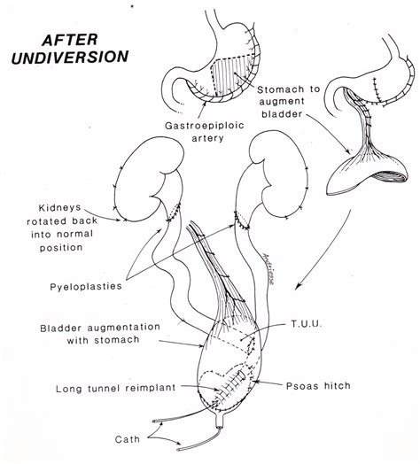 Urinary Tract Reconstruction Patient 4 Undiversion Using Gastric
