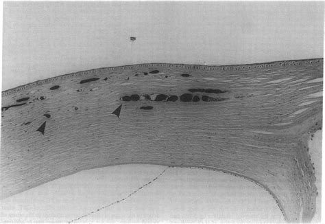 Histologic Appearance Of The Neovascularization Process In The Corneal Download Scientific