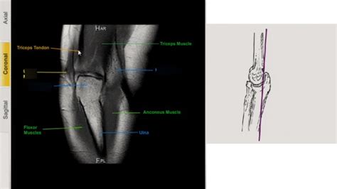 Posterior Elbow Image Diagram Quizlet