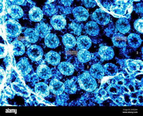 Transmission Electron Micrograph Of Sars Cov 2 Virus Particles Isolated From A Patient Image