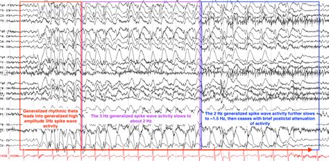 Generalized Seizure Eeg