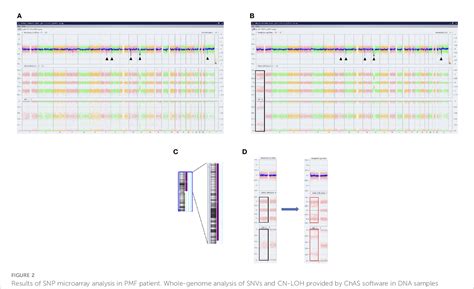 Figure 2 From Leukemic Conversion Involving Ras Mutations Of Type 1 Calr Mutated Primary