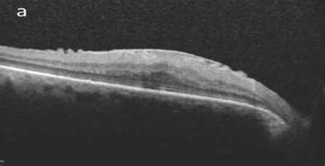 Oct Images At Presentation Showing Erm In The Re A And Cme In The Le Download Scientific