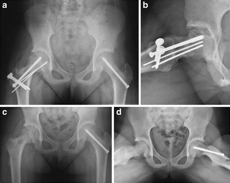 Scfe Treated With Modified Dunn A Pelvic Radiograph Shows