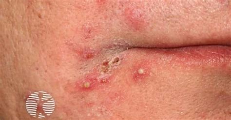 Folliculitis Image