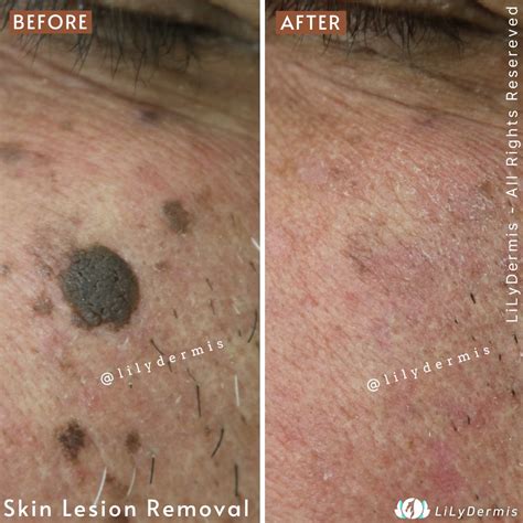Seborrheic Keratosis Removal Lilydermis Calgary