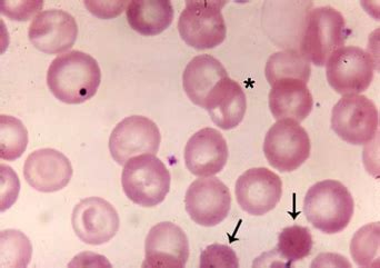 Gambar Kelainan Eritrosit Erytrosit Abnormal CocoQuiins Blog