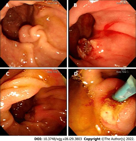 Interval Endoscopic Retrograde Cholangiopancreatography 3 D After The Download Scientific
