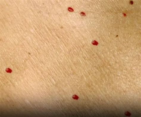 Red Dots On Your Skin Causes And What They Could Mean