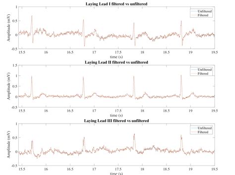 Github Treastorgavinbiosignalsecgsignalprocessing