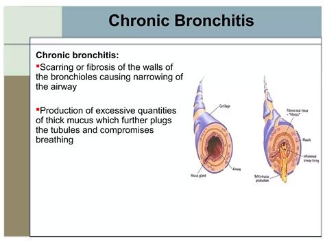 Lecture 5 Asthma And Copd Ppt