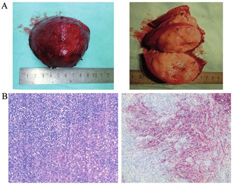 Surgical Specimen And Pathological Analysis A Partial Hepatectomy Download Scientific