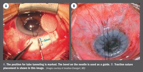 Glaucoma Shunt