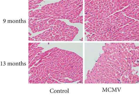 Mcmv Infection Induced Myocardial Remodeling In Mice A Determination