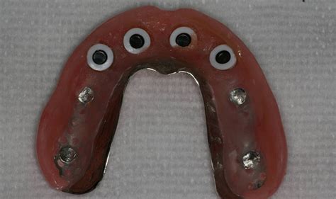 How To Simplify Overdenture Treatment For Todays Patients