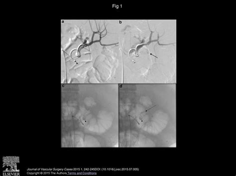 Novel Use Of The Surefire Antireflux Device In Subtotal Splenic